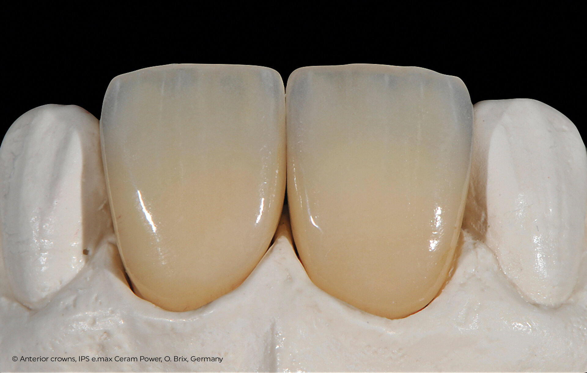 IPS e.max Ceram | Material de revestimiento dental | Ivoclar